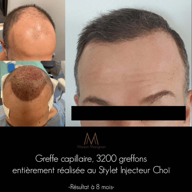 Greffe de cheveux : Le guide complet 2025 - Maison Marignan